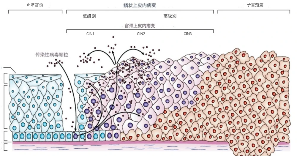 HPV病毒 | Innovation Lab for Vaccine Delivery Research | Duke Kunshan ...